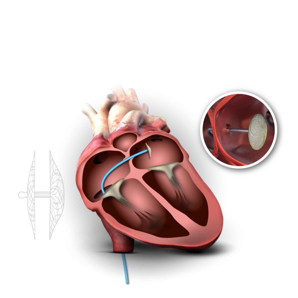 Occlutech PFO Occluder - Cardioplus