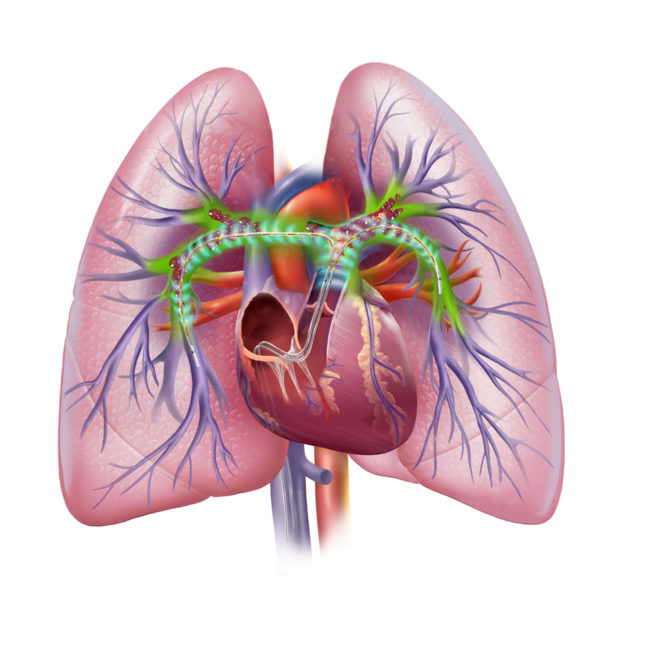 EKOS™ - Endovascular System - Cardioplus