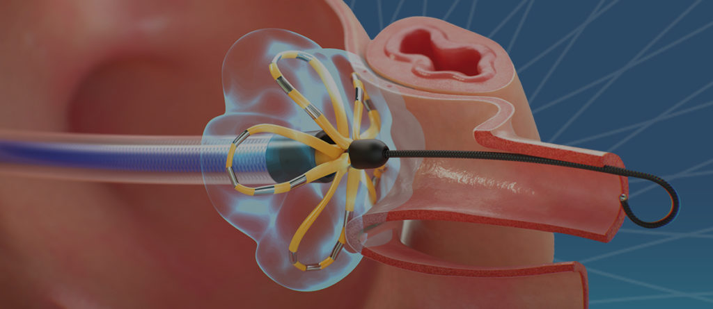 FARAPULSE™ -Pulsed Field Ablation System - Cardioplus